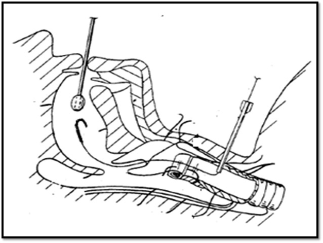 Case report: Retrograde tracheal intubation using a guidewire for a difficult airway in a ...